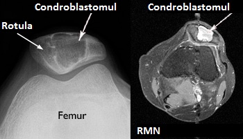 Condroblastomul benign