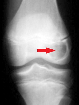 Condroblastomul benign