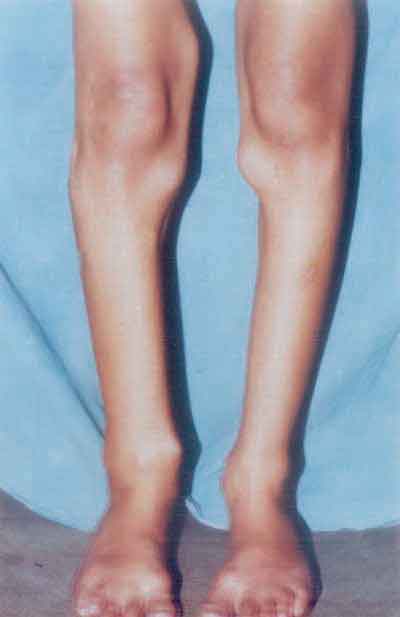 Exostoze osteogenice