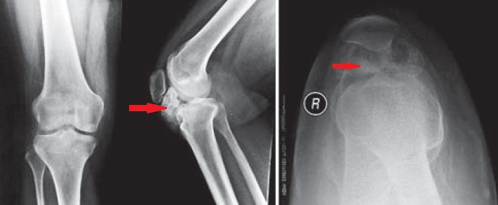 Exostoze osteogenice