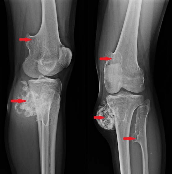Exostoze osteogenice