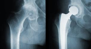 Coxartroza