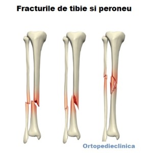 Fractura diafizei tibiale