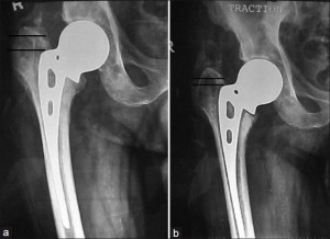 Artroplastia soldului