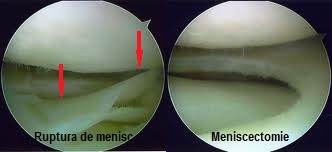 Meniscectomia / Sutura de menisc