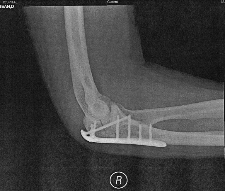 Fractura de olecran