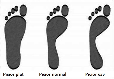 Piciorul plat valg (platfus)