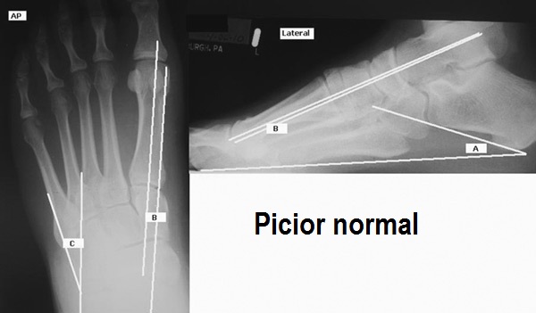 Piciorul plat valg (platfus)