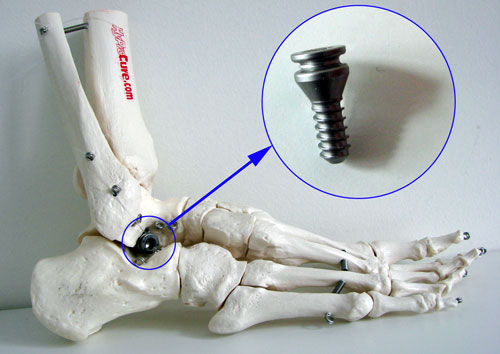 Piciorul plat valg (platfus)