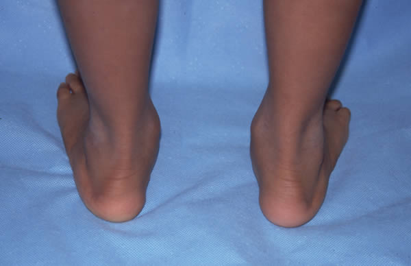 Piciorul plat valg (platfus)