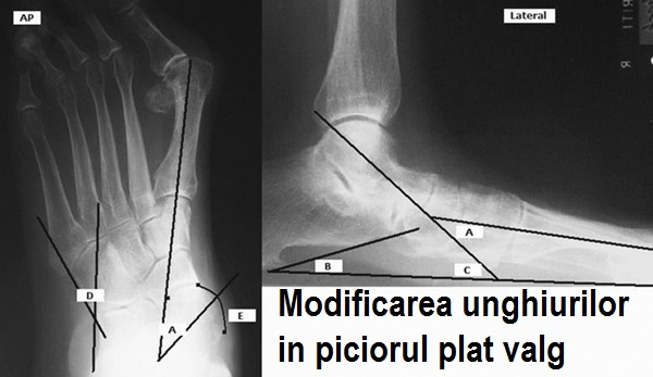 Piciorul plat valg (platfus)