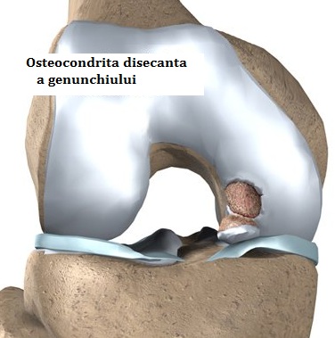 Osteocondrita disecanta a genunchiului