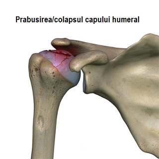 Osteonecroza avasculara a capului humeral