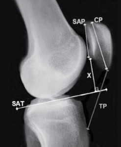 Luxatie recidivanta de rotula